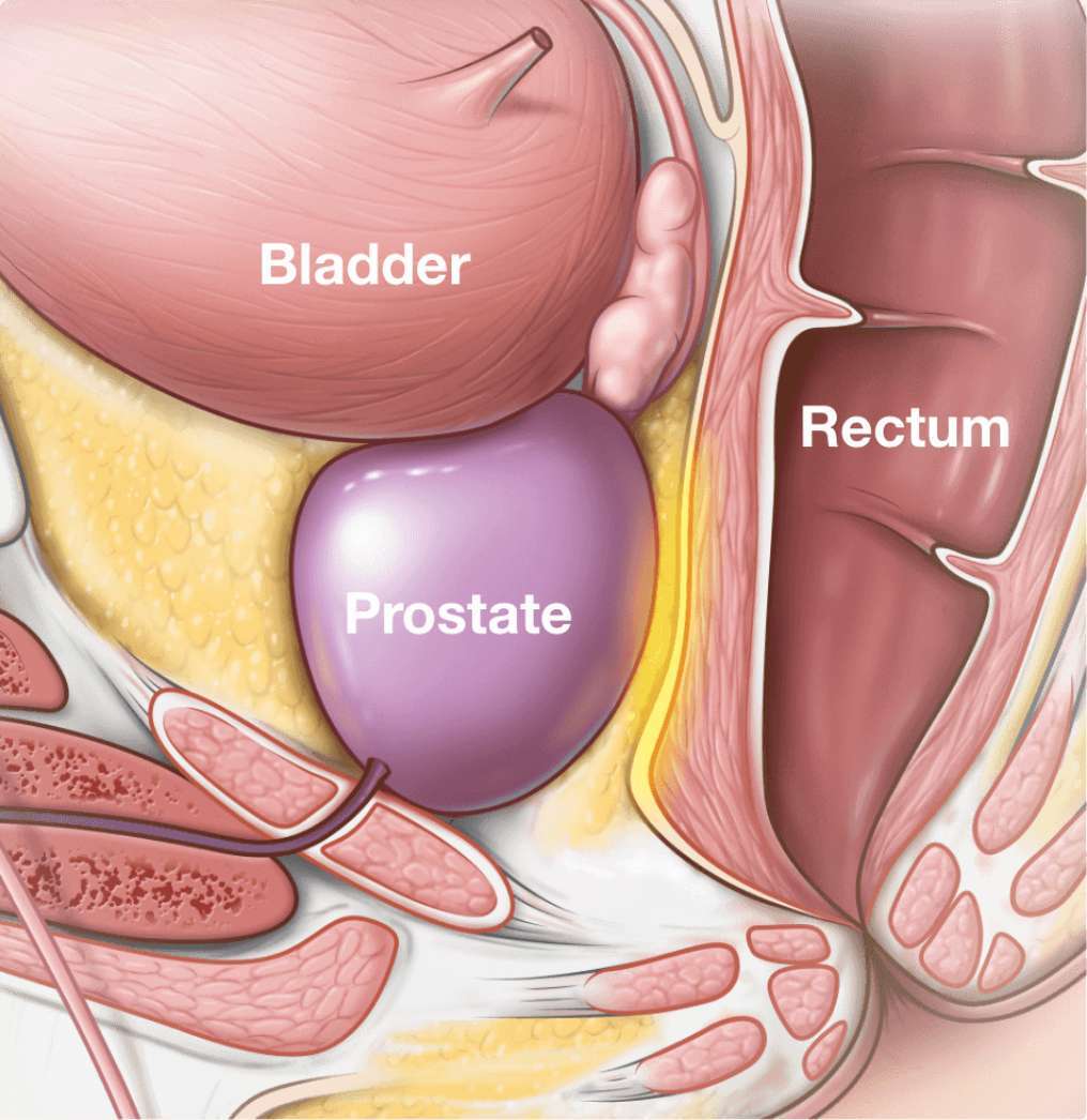 About Your Barrigel Procedure for Prostate Cancer Radiation
